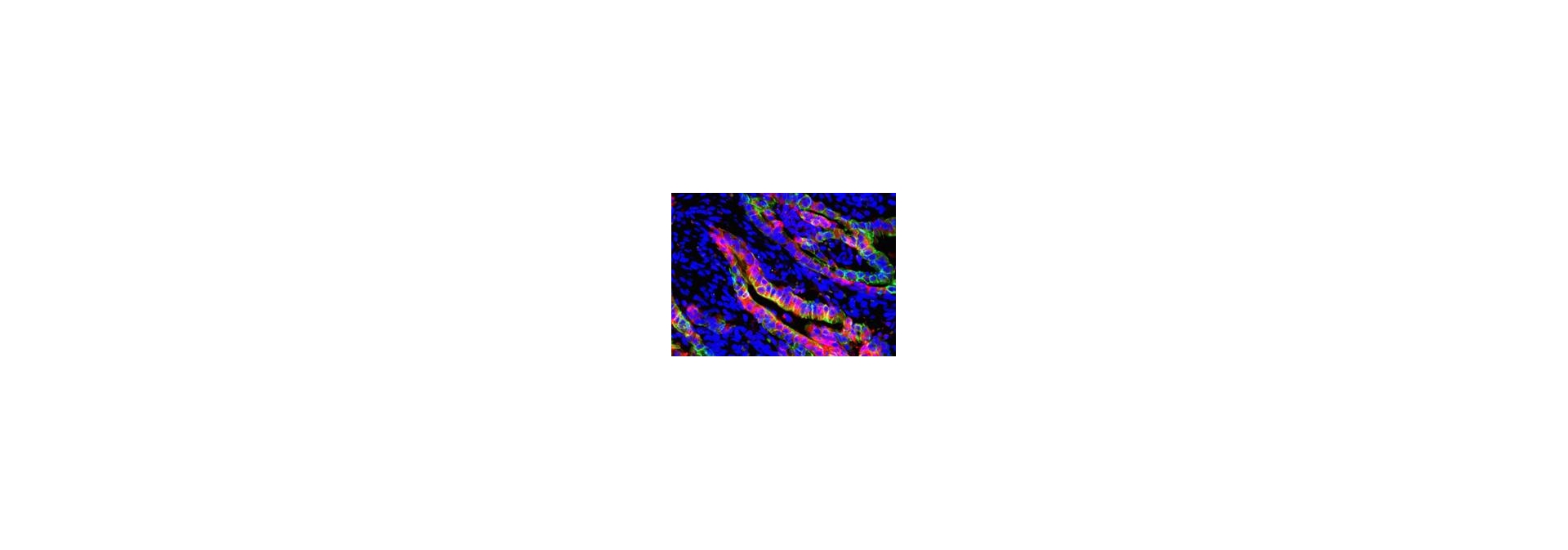 Pancreatic Tumors May Require a One-Two-Three Punch | University of ...