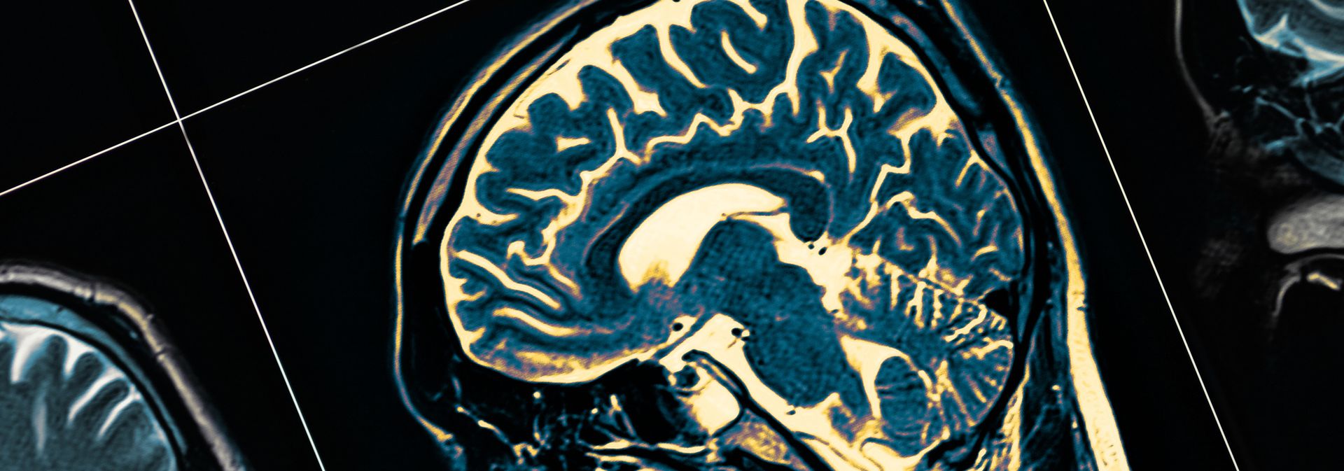 Copper Identified as Culprit in Alzheimer’s Disease | University of ...