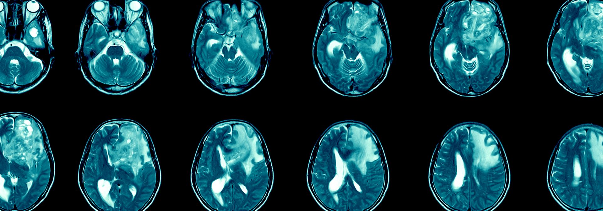 Personalized Immune Therapy Extended Survival in Patients with ...