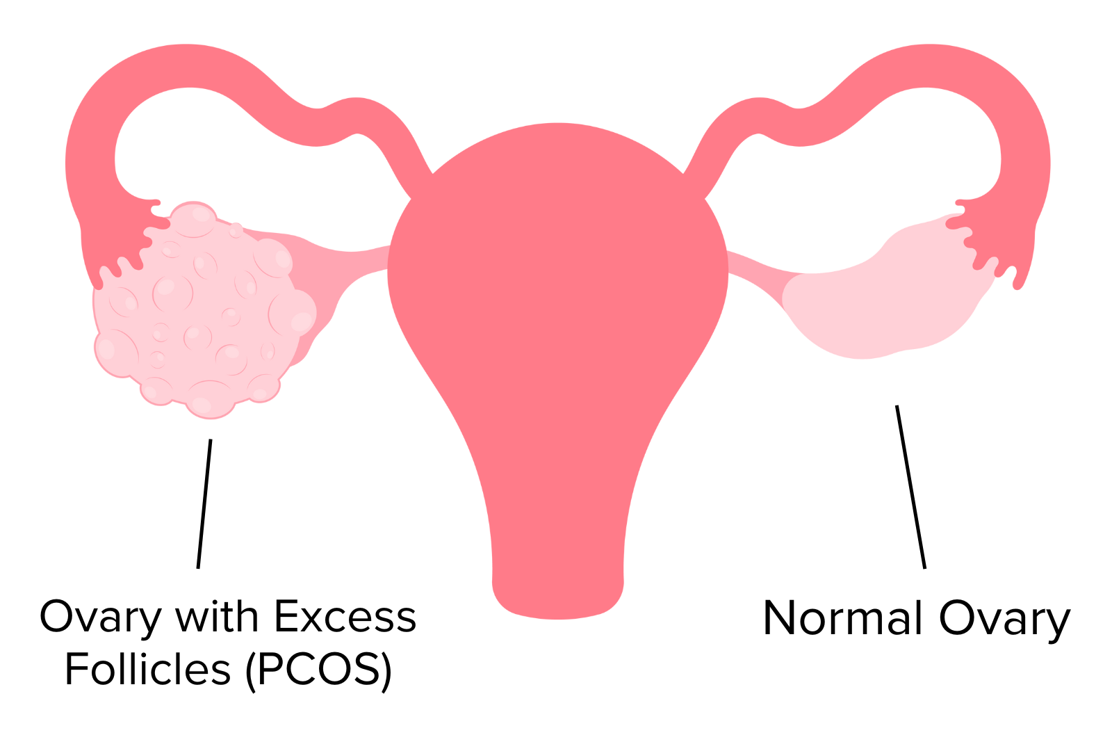 How Common is PCOS and Why You Might Already Have It? | URMC Newsroom