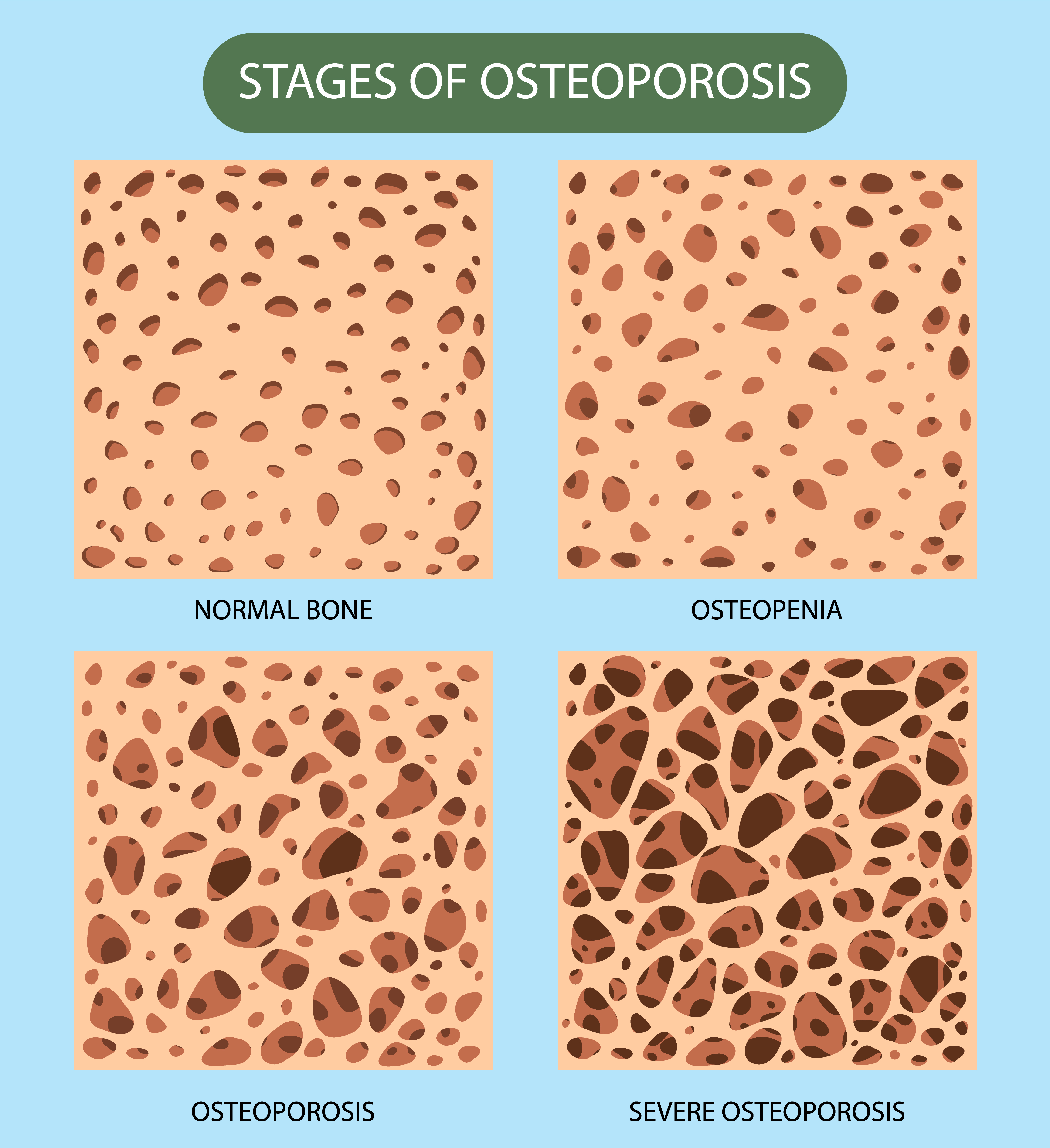 What is a Bone Density Scan (DEXA)? | URMC Newsroom