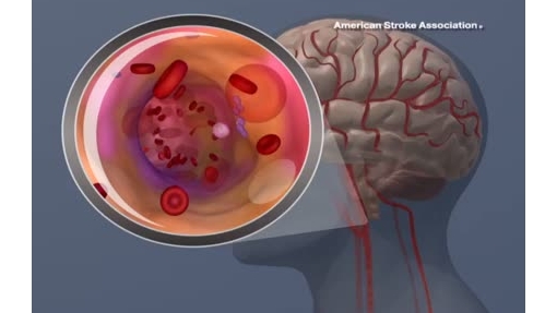 Heart Association Animations | American Heart Association