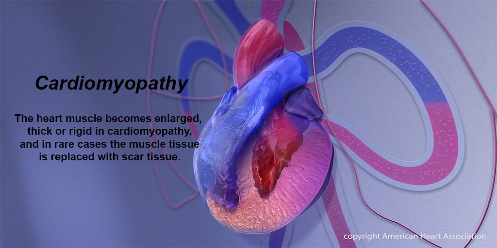 AHA/ASA Medical Graphics and Illustrations | American Heart Association