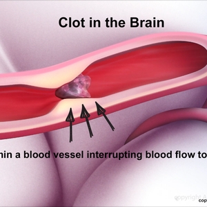 AHA/ASA Medical Graphics and Illustrations | American Heart Association