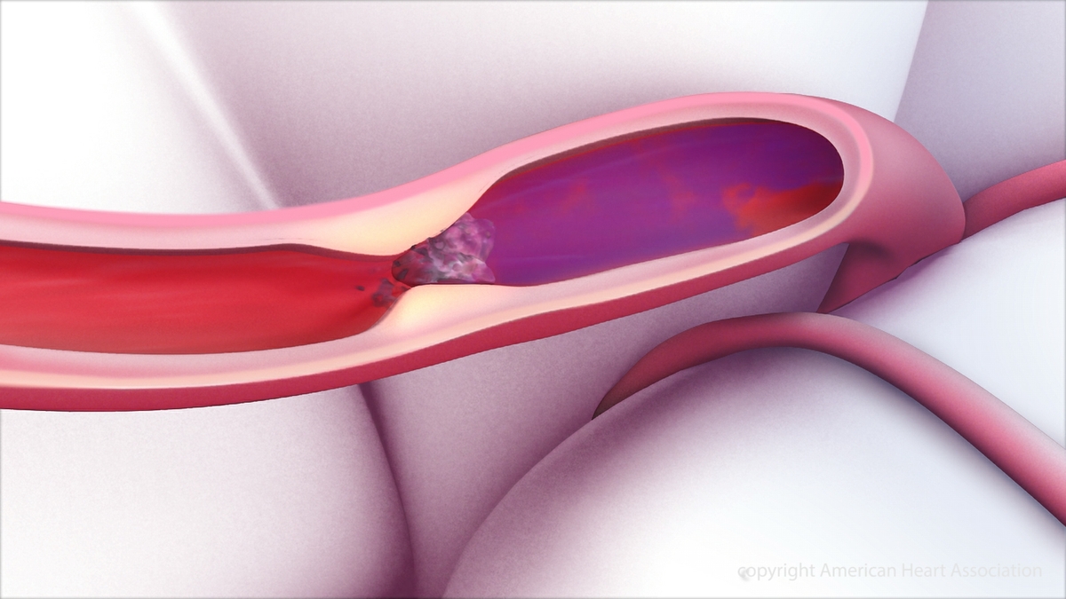 AHA/ASA Medical Graphics and Illustrations | American Heart Association