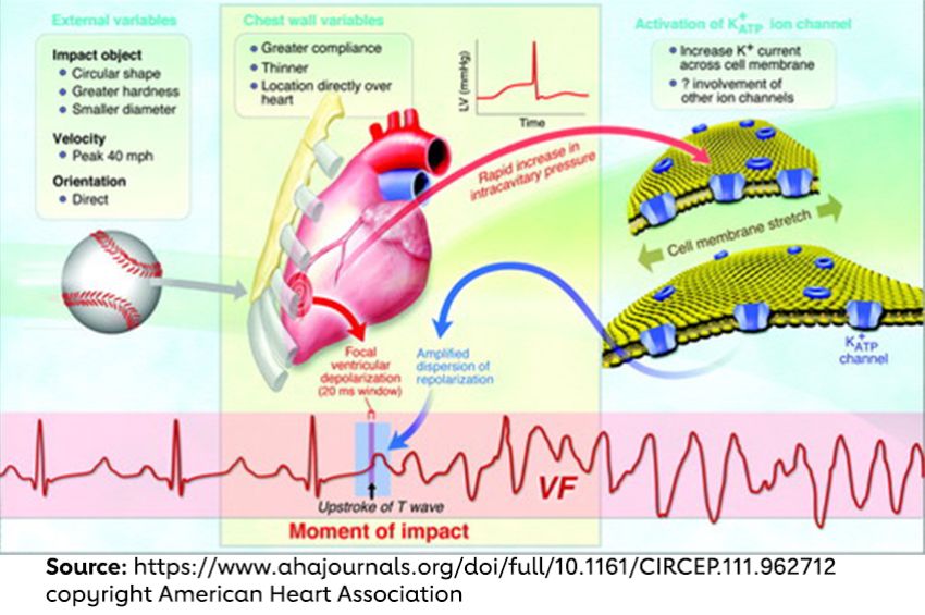 Commotio cordis is extremely rare; quick action essential: call 911 ...