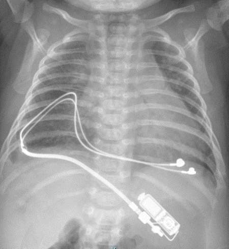 Tiny pacemakers safely stabilize newborns’ hearts for up to two years ...